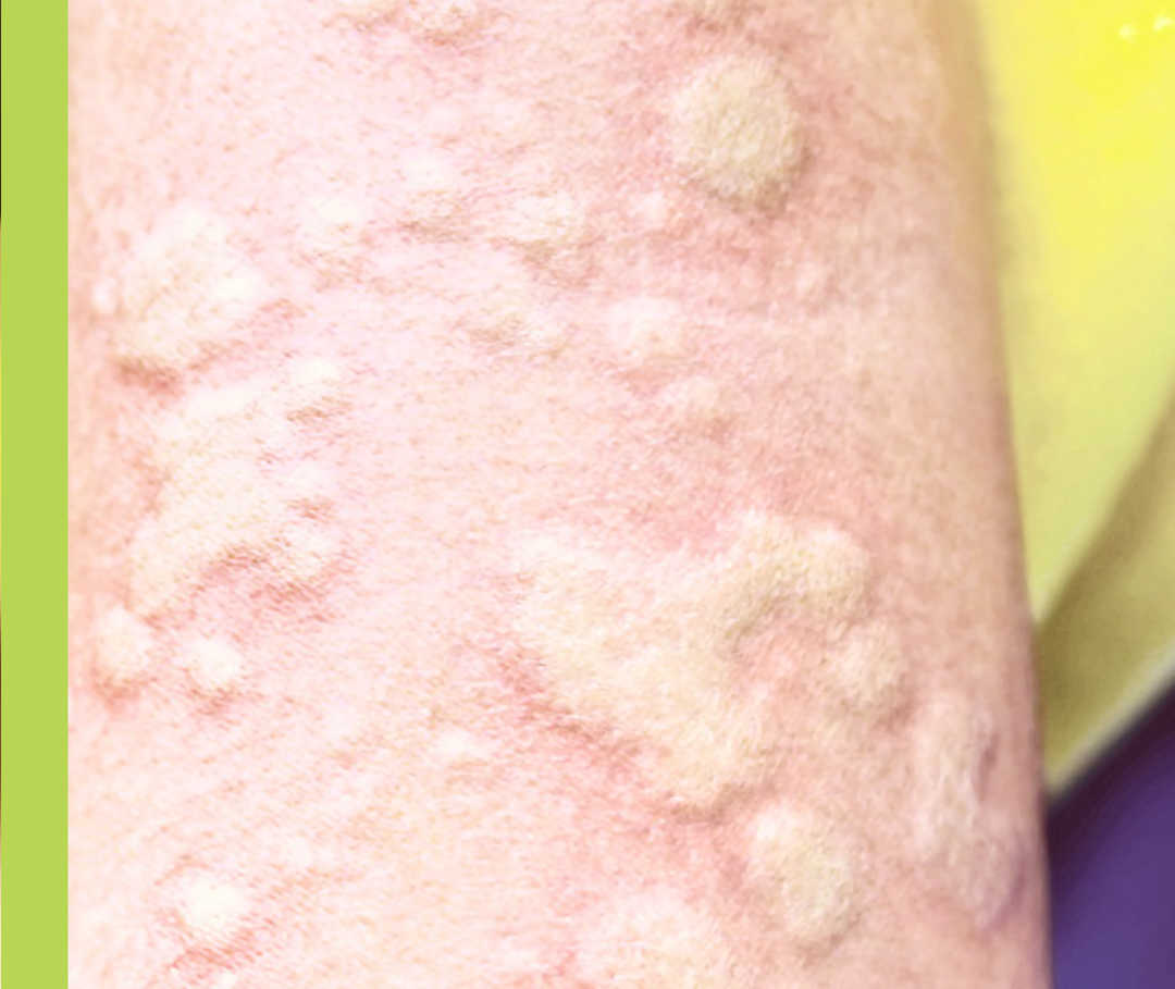 Nesselsucht: So erkennst du die Symptome | HAUTWENDE